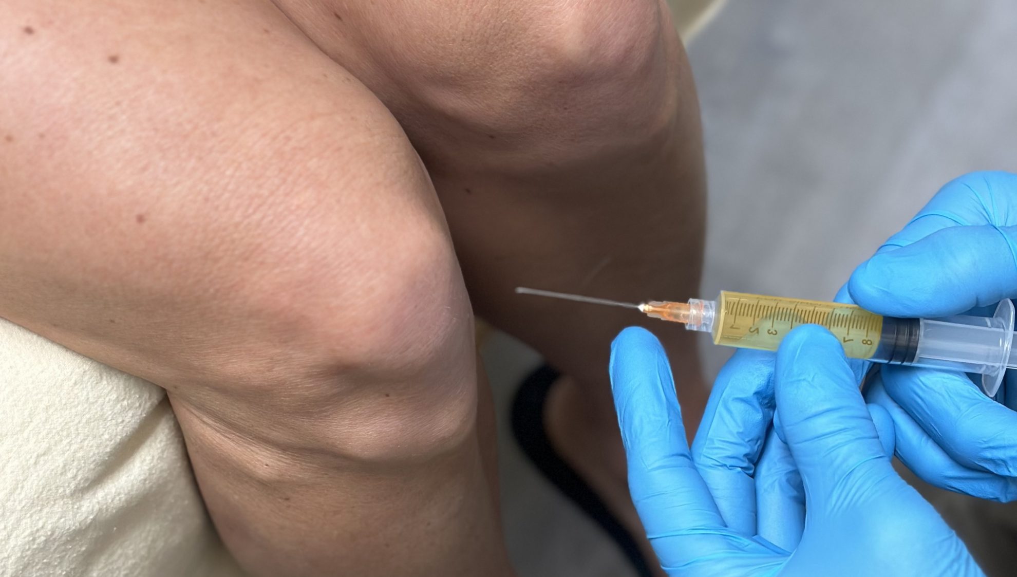 Platelet-Rich Plasma Injection For Knees